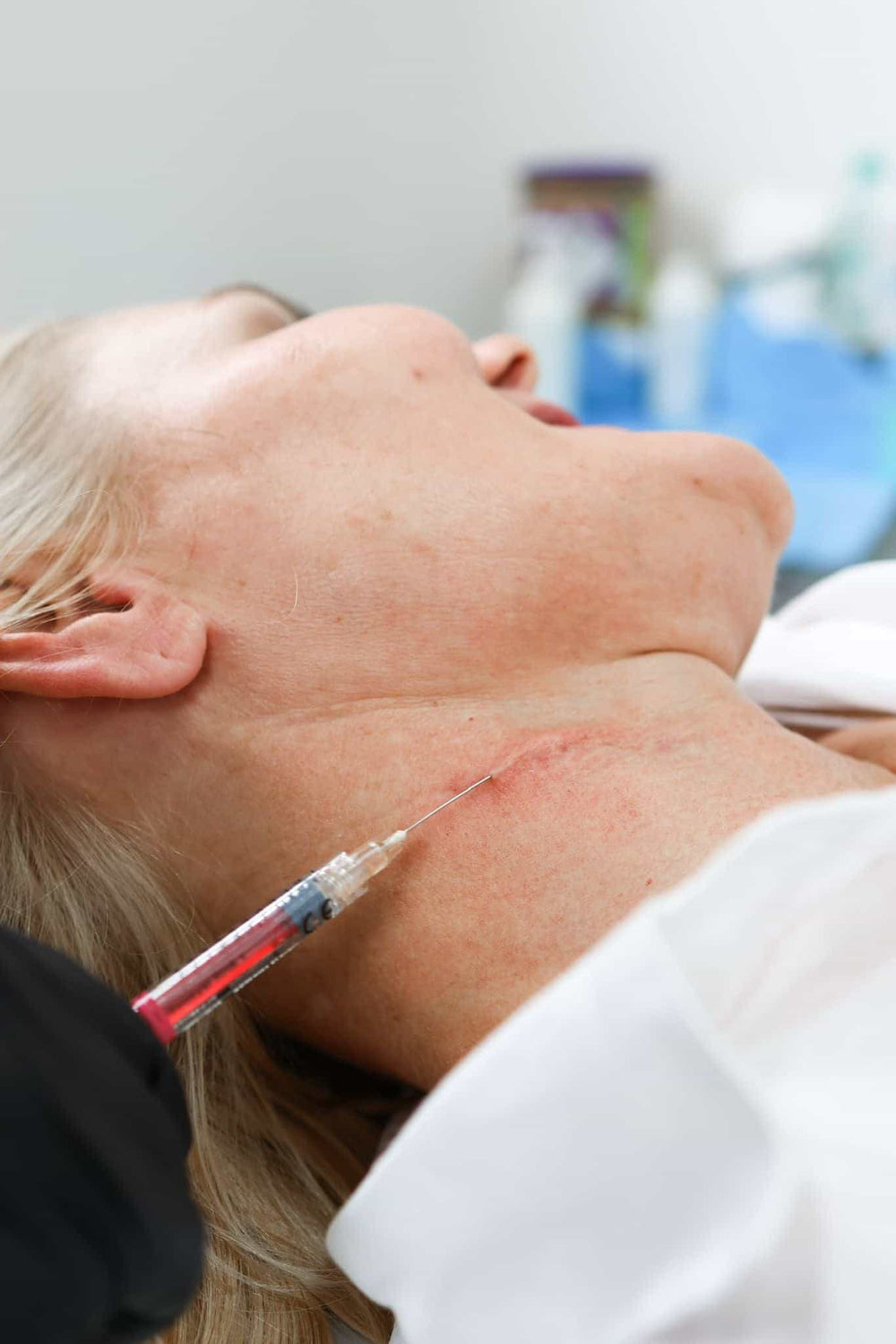 Neck Line Filler Treatment - Kingston Upon Thames, Surrey, London – It ...
