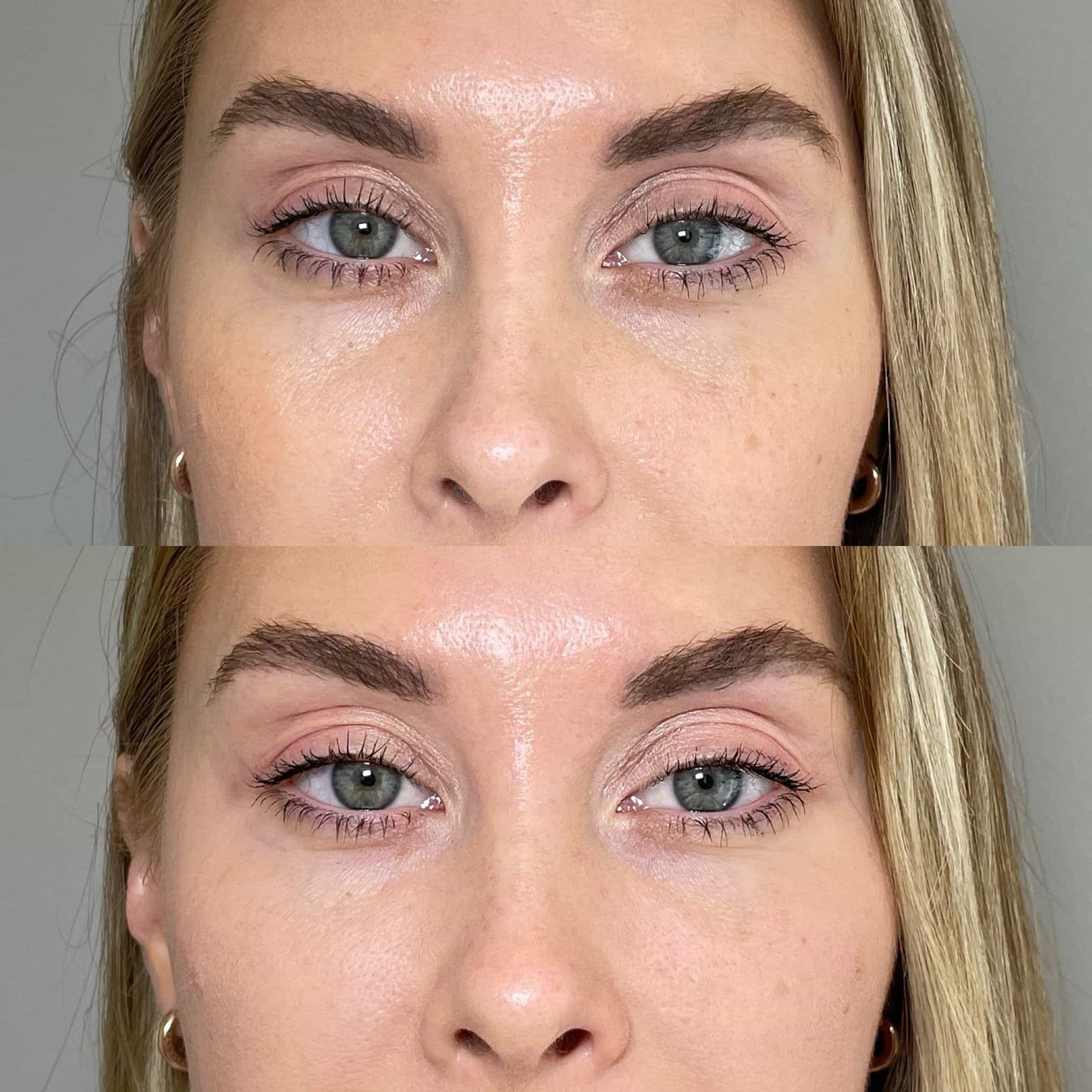 Tear Trough Filler - Under Eye Filler - Kingston Upon Thames, Surrey ...